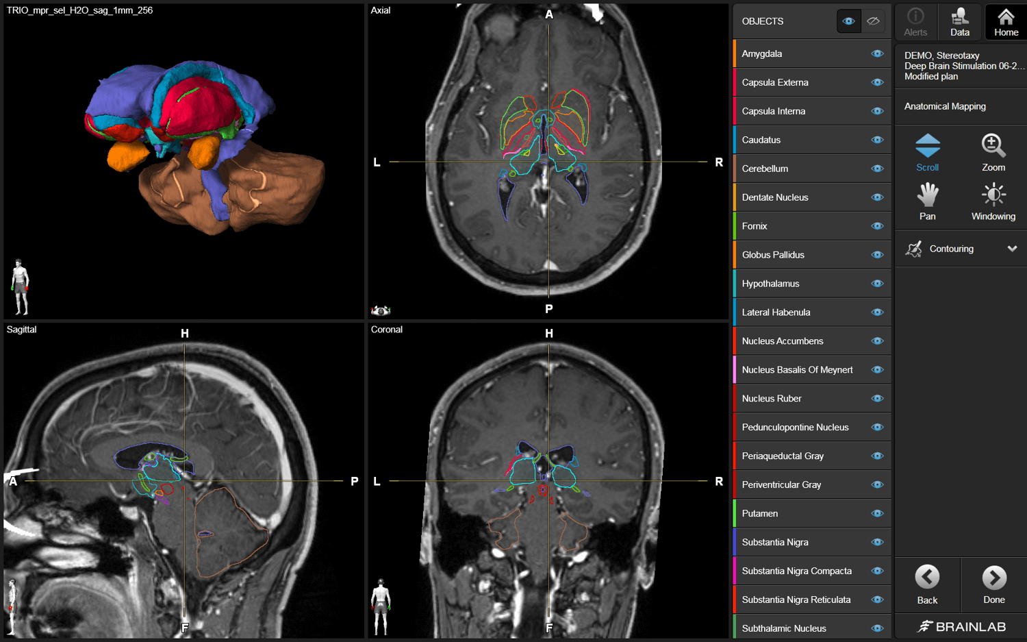 Cranial Functional Workflow: Treatment Planning | Brainlab